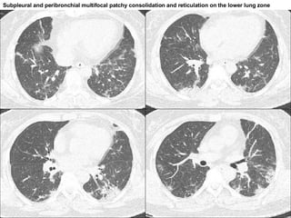 Diffuse alveolar damage | PPT