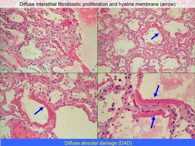 Diffuse alveolar damage | PPT