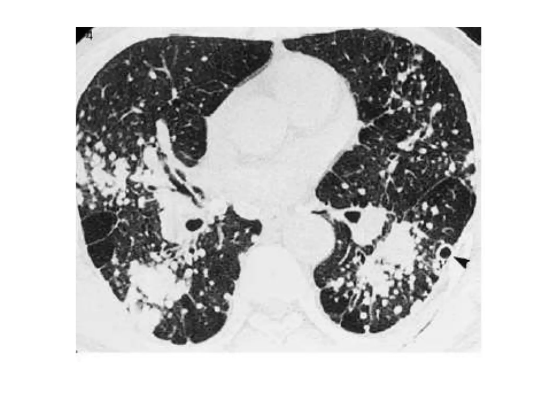 Interstitial lung disease Radiology | PPTX