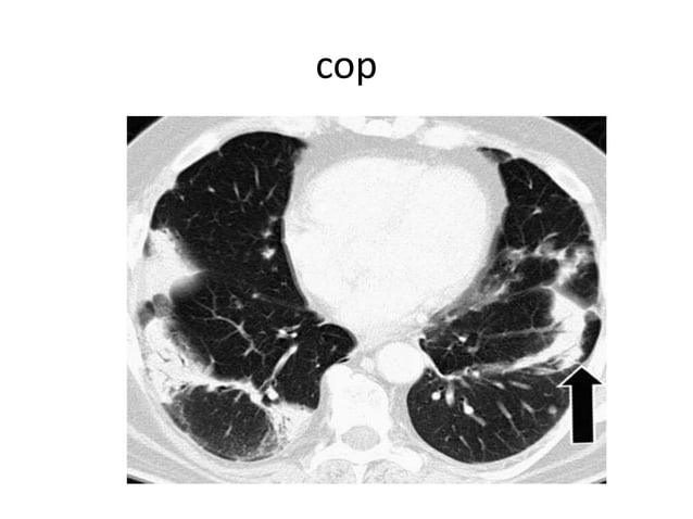Interstitial lung disease Radiology | PPTX