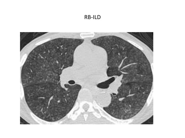 Interstitial lung disease Radiology | PPTX