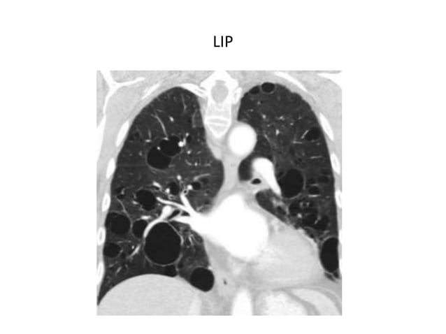 Interstitial lung disease Radiology | PPTX