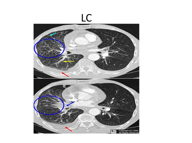 Interstitial lung disease Radiology | PPTX