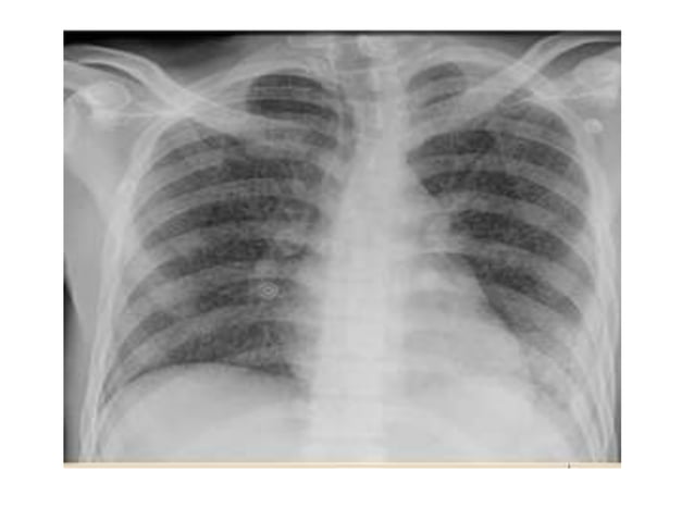Interstitial lung disease Radiology | PPTX