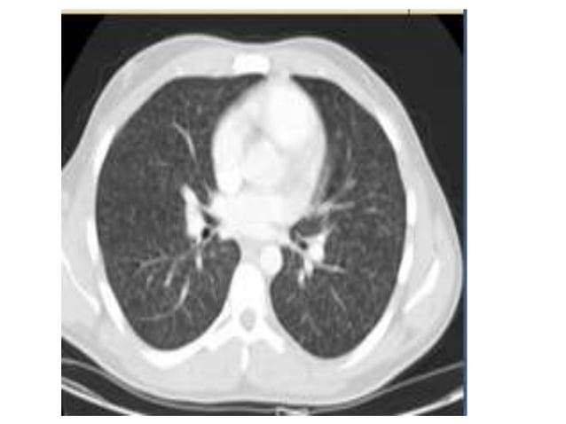 Interstitial lung disease Radiology | PPTX