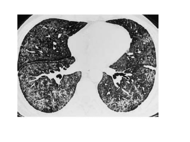 Interstitial lung disease Radiology | PPTX