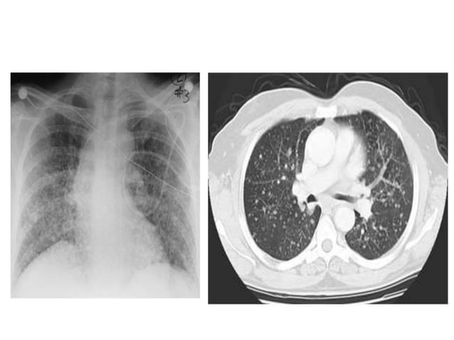 Interstitial lung disease Radiology | PPTX
