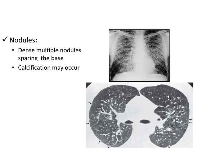 Interstitial lung disease Radiology | PPTX