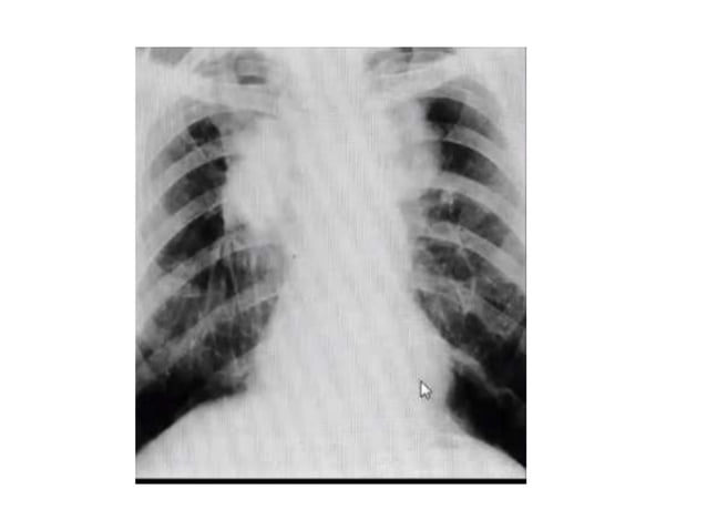 Interstitial lung disease Radiology | PPTX