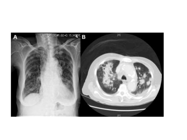 Interstitial lung disease Radiology | PPTX