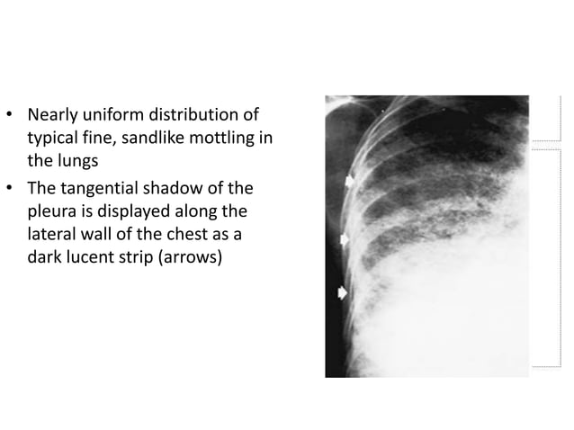 Interstitial lung disease Radiology | PPTX