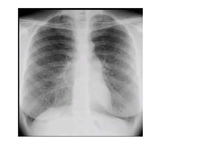 Interstitial lung disease Radiology | PPTX