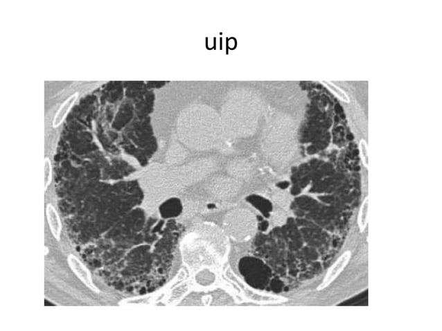 Interstitial lung disease Radiology | PPTX