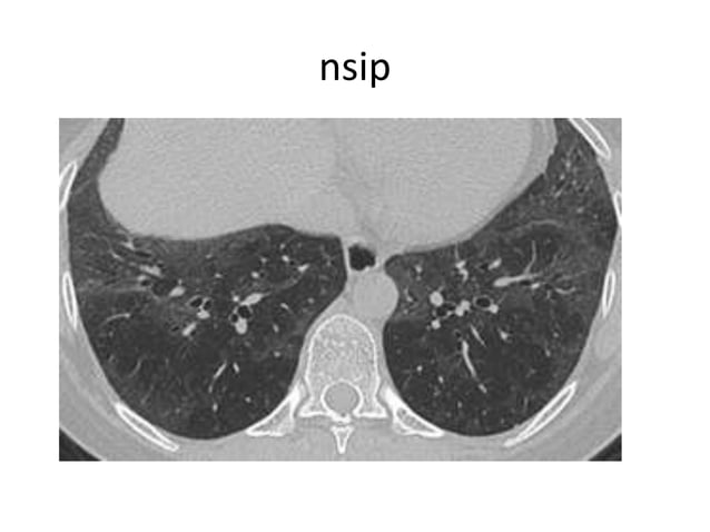 Interstitial lung disease Radiology | PPTX