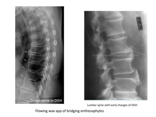 Diffuse idiopathic skeletal hyperostosis | PPTX