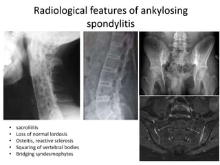 Diffuse idiopathic skeletal hyperostosis | PPTX