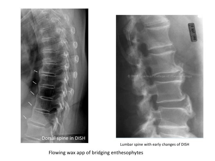 Diffuse idiopathic skeletal hyperostosis