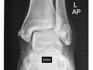 Diffuse Idiopathic Skeletal Hyperostosis Foot