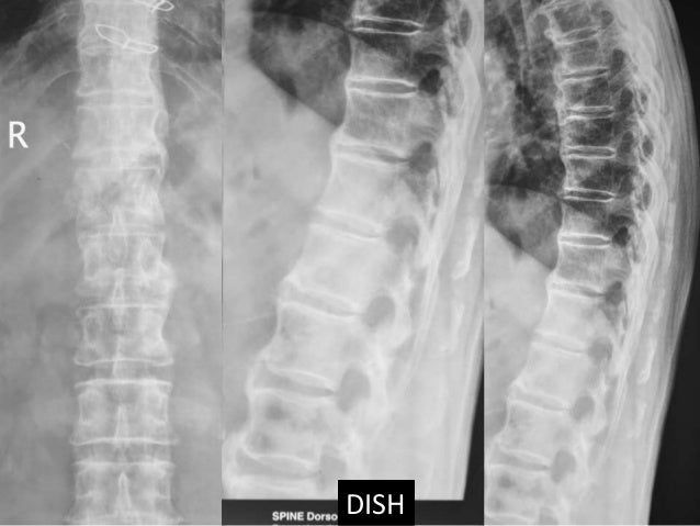 Diffuse idiopathic skeletal hyperostosis