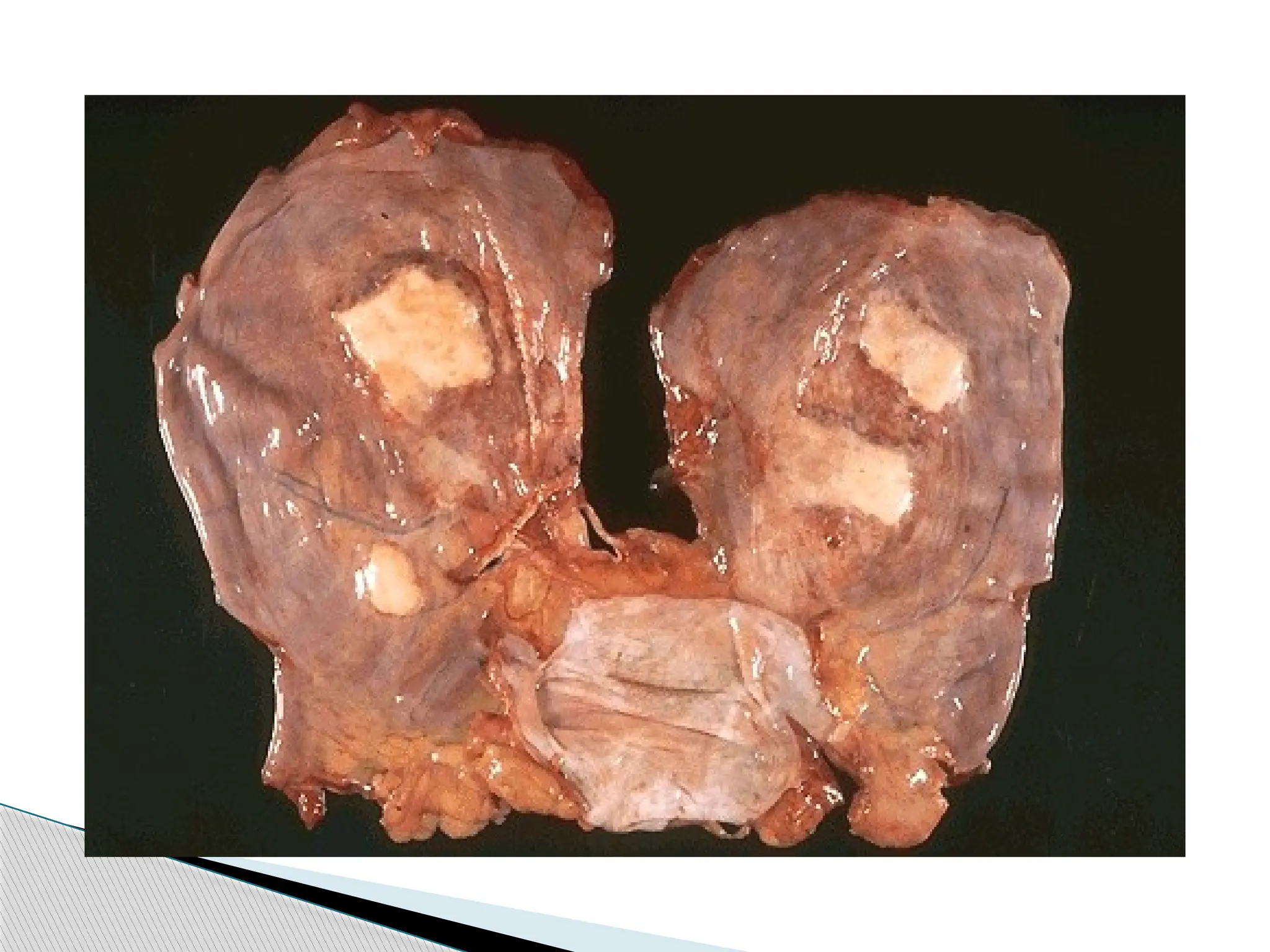 Diffuse interstitial lung disease.pptx med | PPT