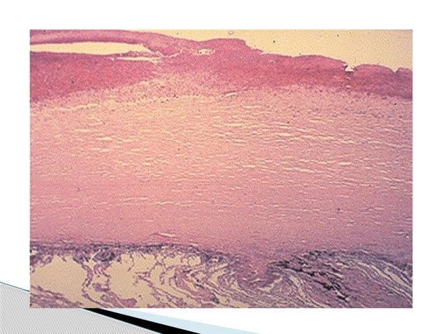 Diffuse interstitial lung disease.pptx med | PPT