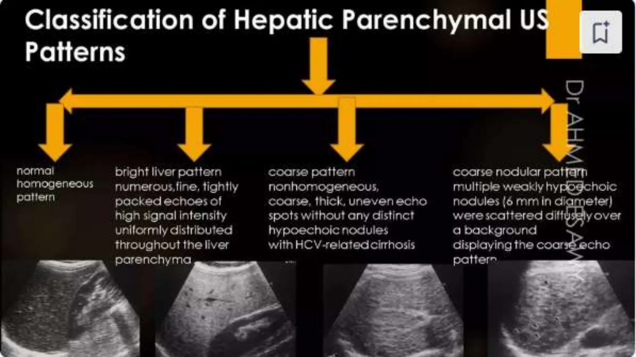 DIFFUSE LIVER DISEASES AND THEIR APPEARANCE IN ULTRASOUND | PPTX
