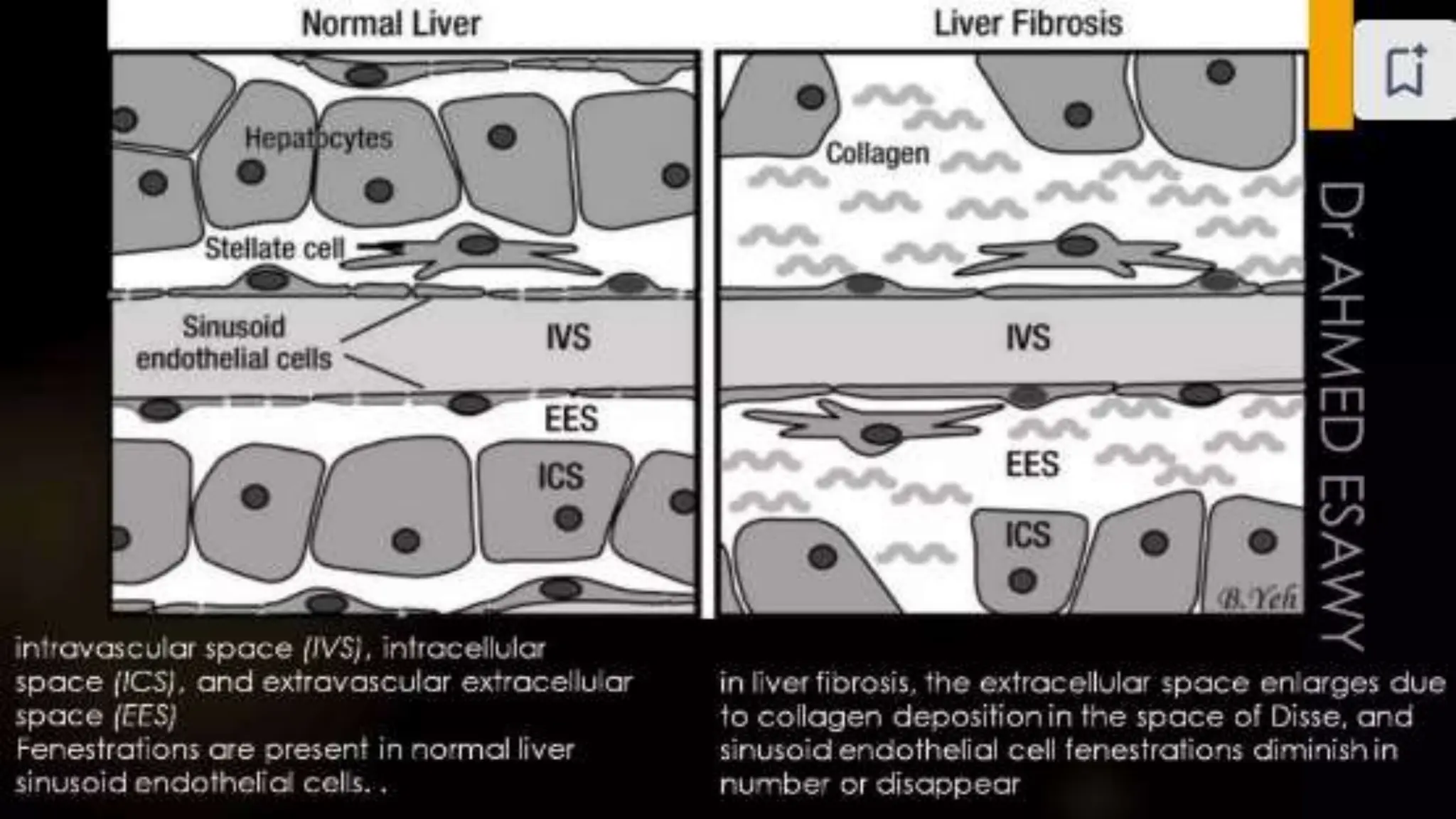 DIFFUSE LIVER DISEASES AND THEIR APPEARANCE IN ULTRASOUND | PPTX
