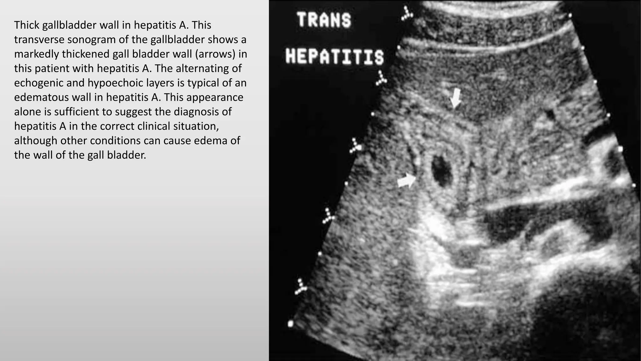 DIFFUSE LIVER DISEASES AND THEIR APPEARANCE IN ULTRASOUND | PPTX