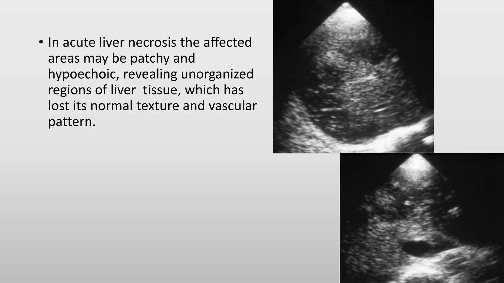 DIFFUSE LIVER DISEASES AND THEIR APPEARANCE IN ULTRASOUND | PPTX