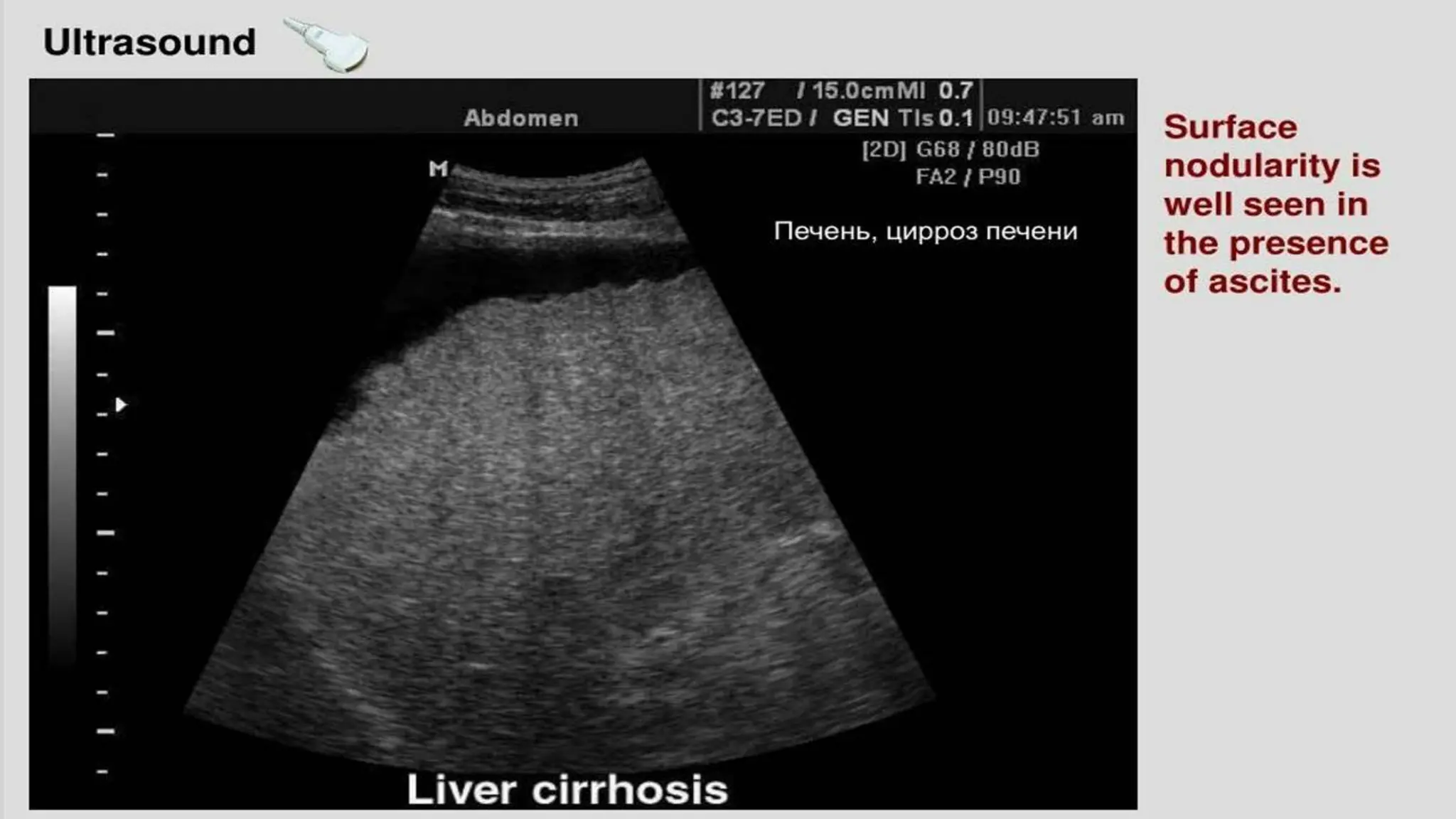 DIFFUSE LIVER DISEASES AND THEIR APPEARANCE IN ULTRASOUND | PPTX