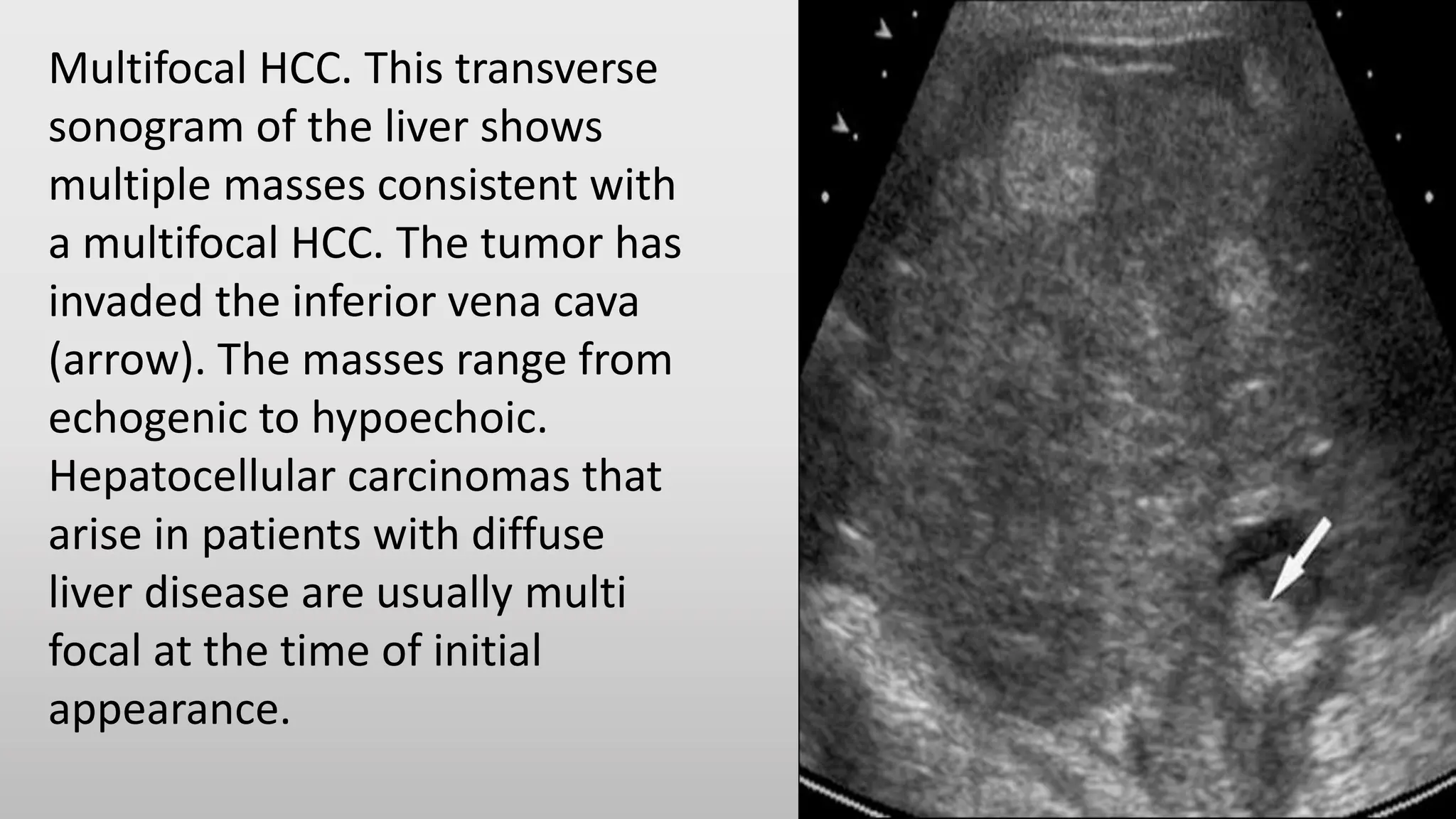 DIFFUSE LIVER DISEASES AND THEIR APPEARANCE IN ULTRASOUND | PPTX