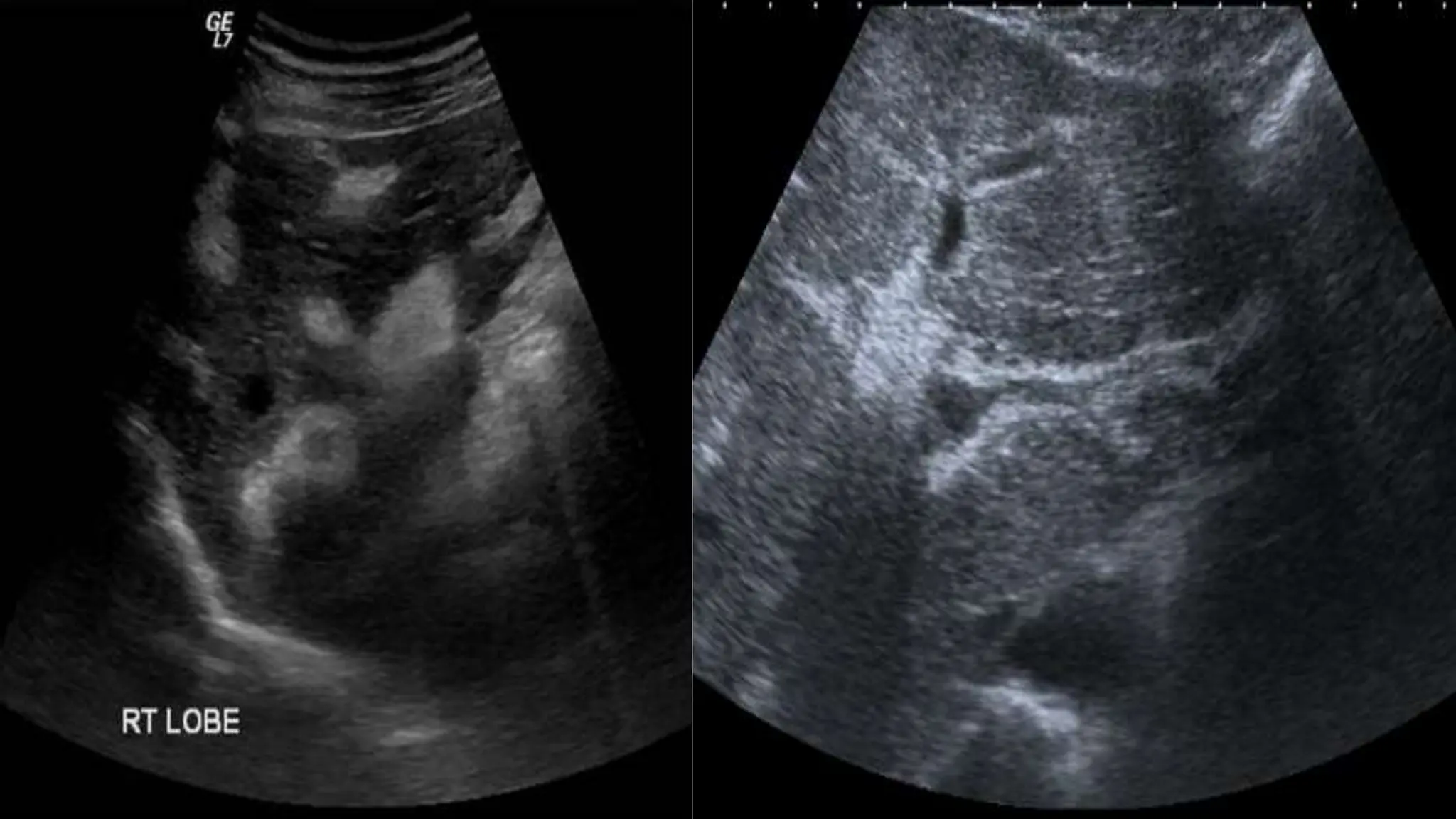 DIFFUSE LIVER DISEASES AND THEIR APPEARANCE IN ULTRASOUND | PPTX
