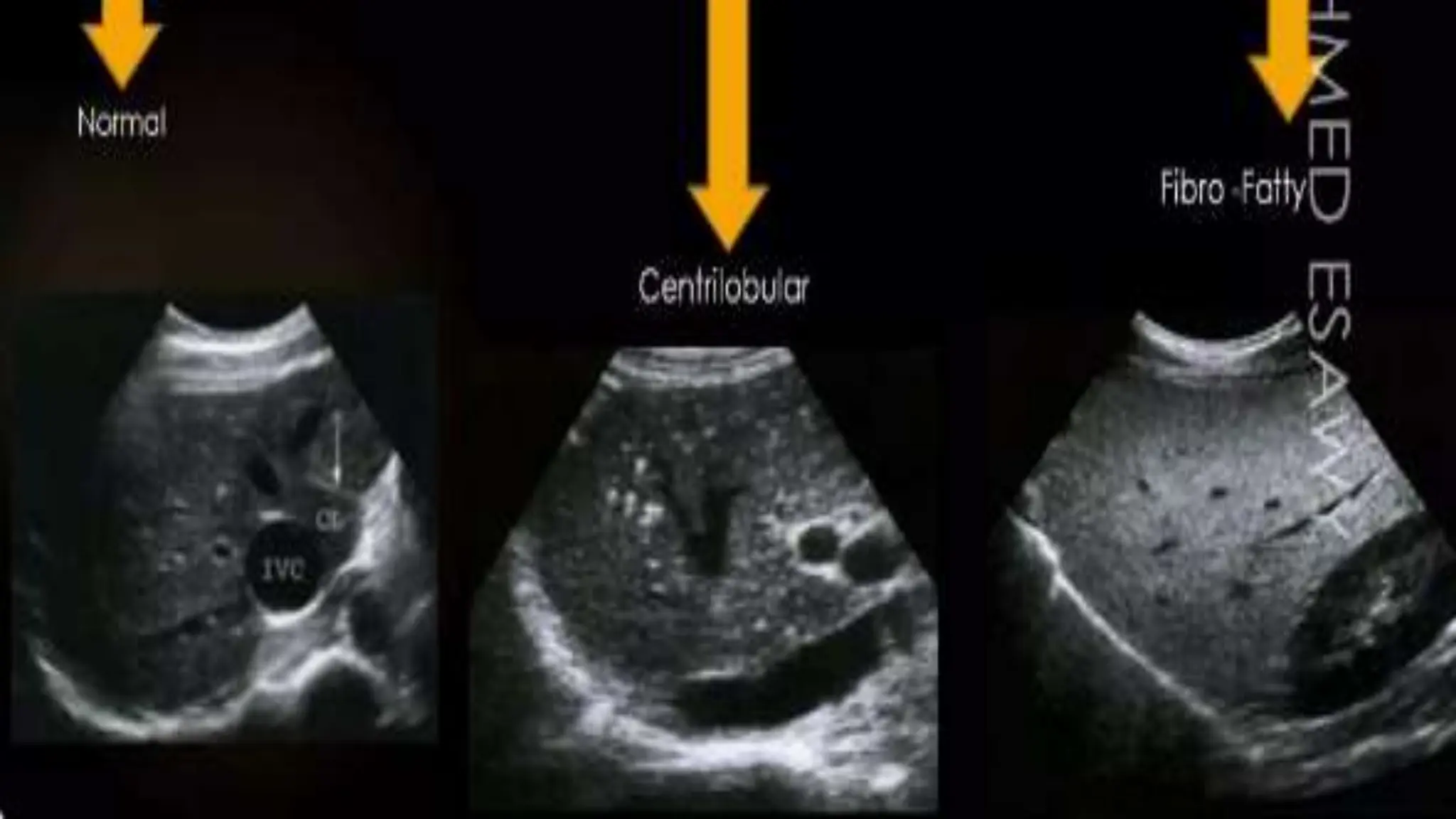 DIFFUSE LIVER DISEASES AND THEIR APPEARANCE IN ULTRASOUND | PPTX