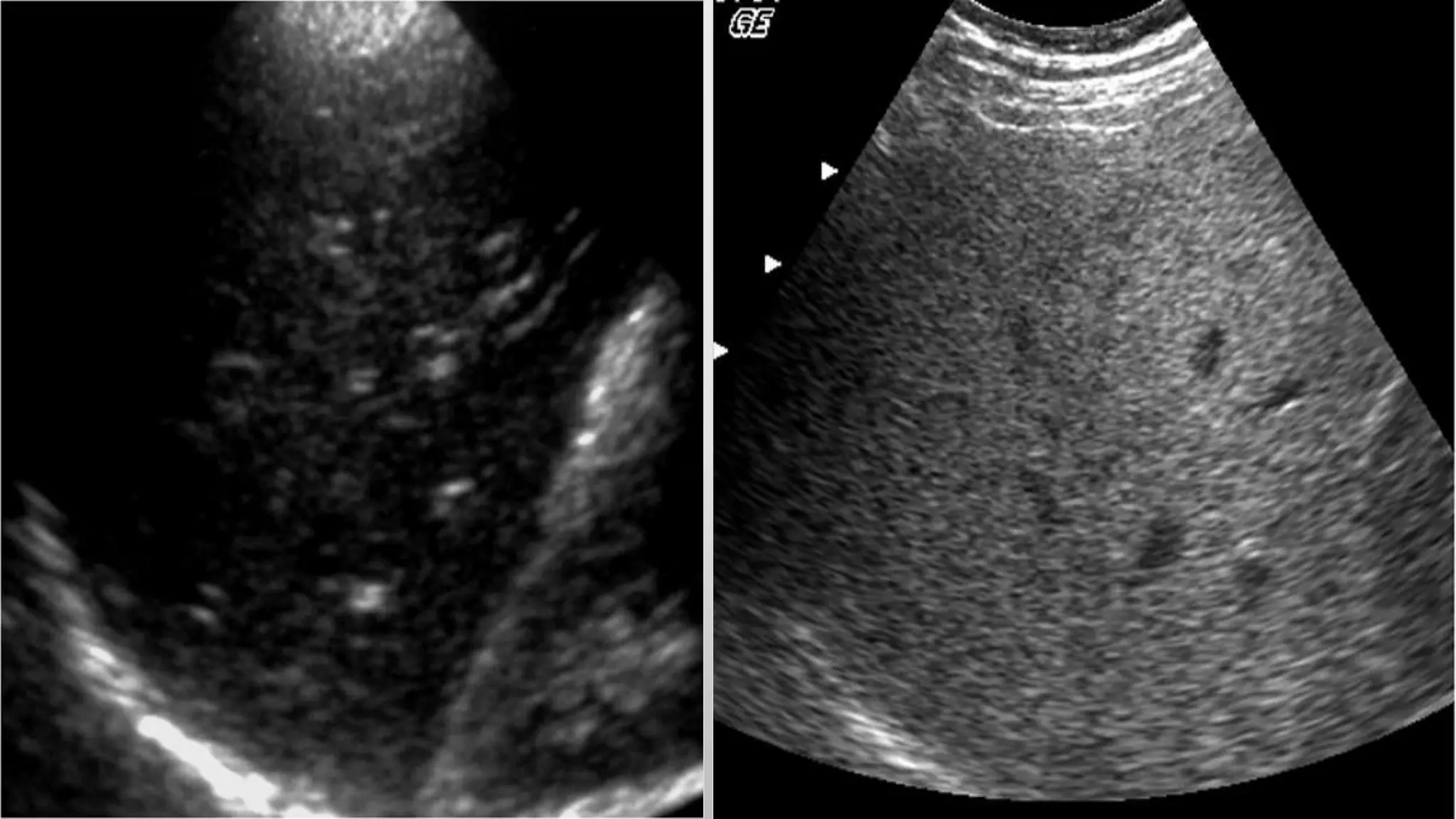 DIFFUSE LIVER DISEASES AND THEIR APPEARANCE IN ULTRASOUND | PPTX