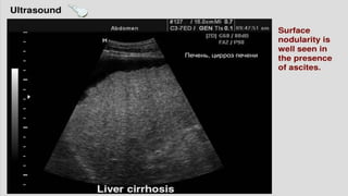 DIFFUSE LIVER DISEASES AND THEIR APPEARANCE IN ULTRASOUND | PPTX