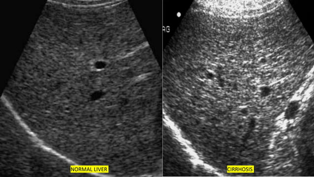 DIFFUSE LIVER DISEASES AND THEIR APPEARANCE IN ULTRASOUND | PPTX