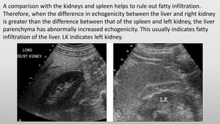 DIFFUSE LIVER DISEASES AND THEIR APPEARANCE IN ULTRASOUND | PPTX