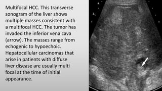 DIFFUSE LIVER DISEASES AND THEIR APPEARANCE IN ULTRASOUND | PPTX