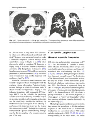 Diffuse lung disease | PDF