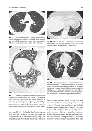 Diffuse lung disease | PDF