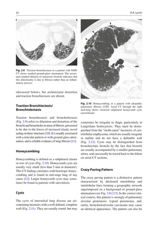 Diffuse lung disease | PDF
