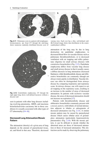 Diffuse lung disease | PDF