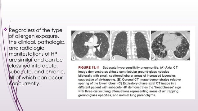 Radiological approach to Diffuse Lung Disease | PPT