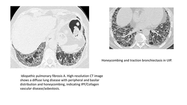 HRCT chest in Diffuse lung disease by Dr. Subash Pathak | PPT