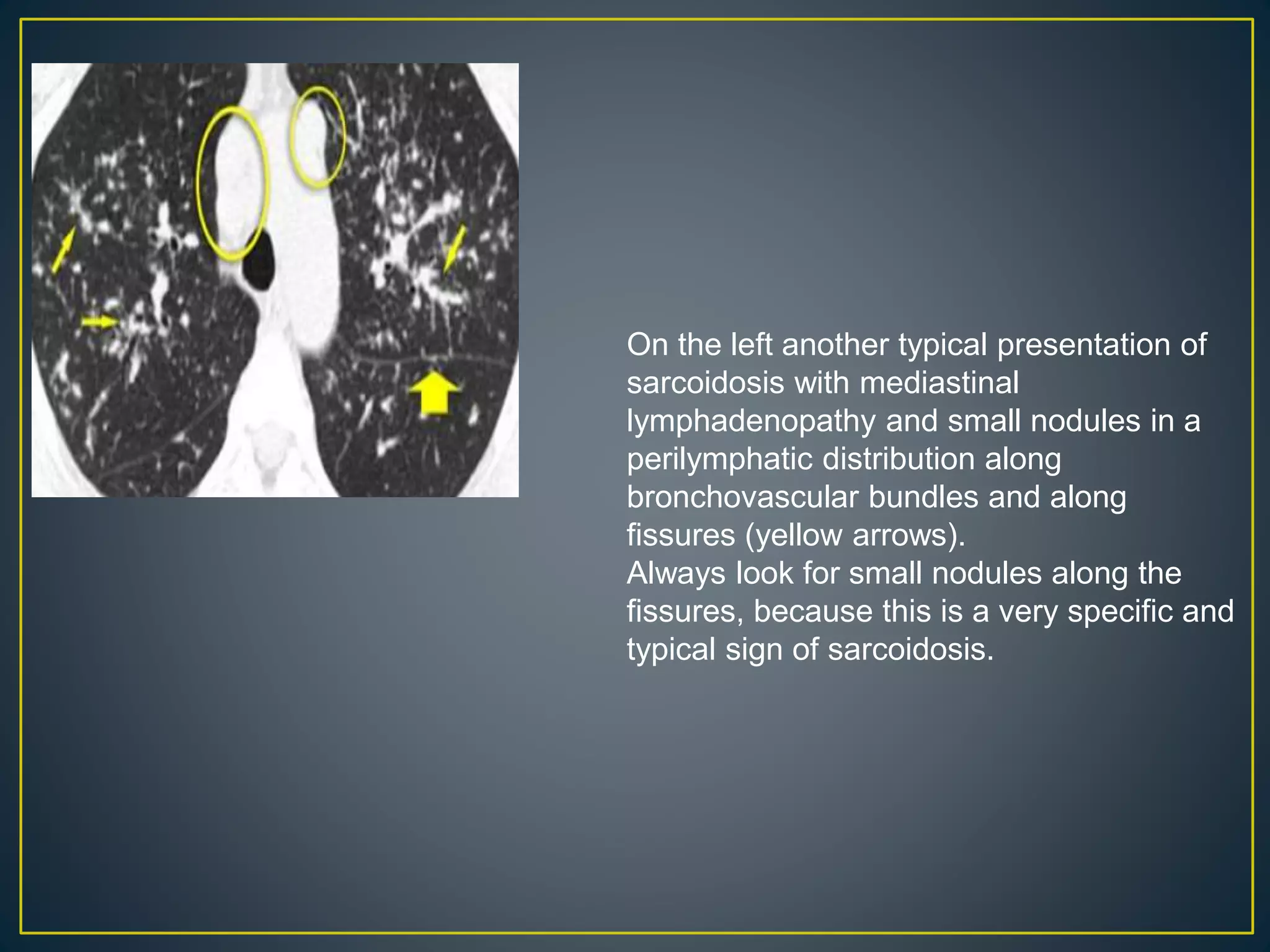 DIFFUSE LUNG DISEASES.pptx