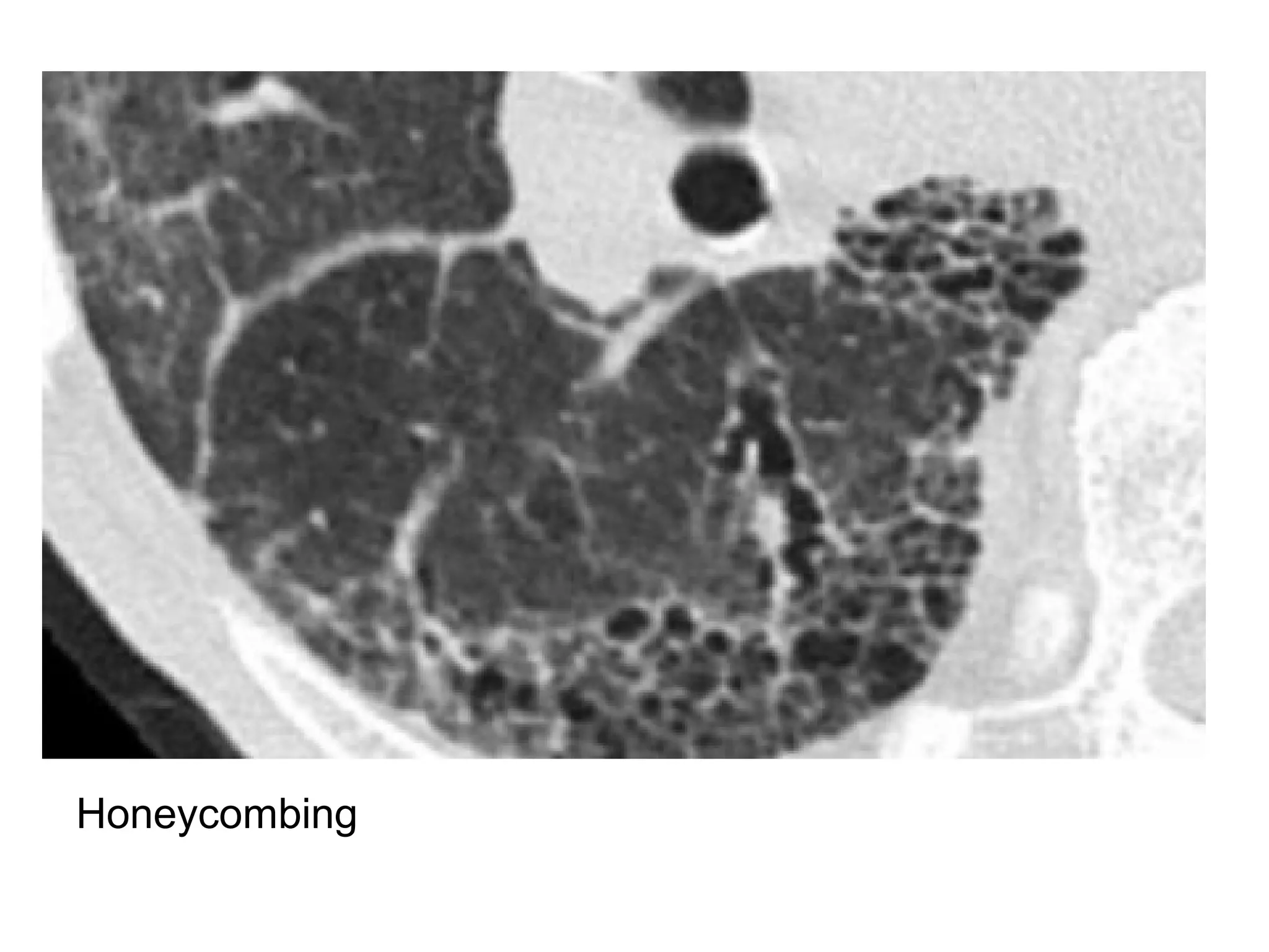 Diagnostic Imaging of Diffuse Lung Lesions | PPT