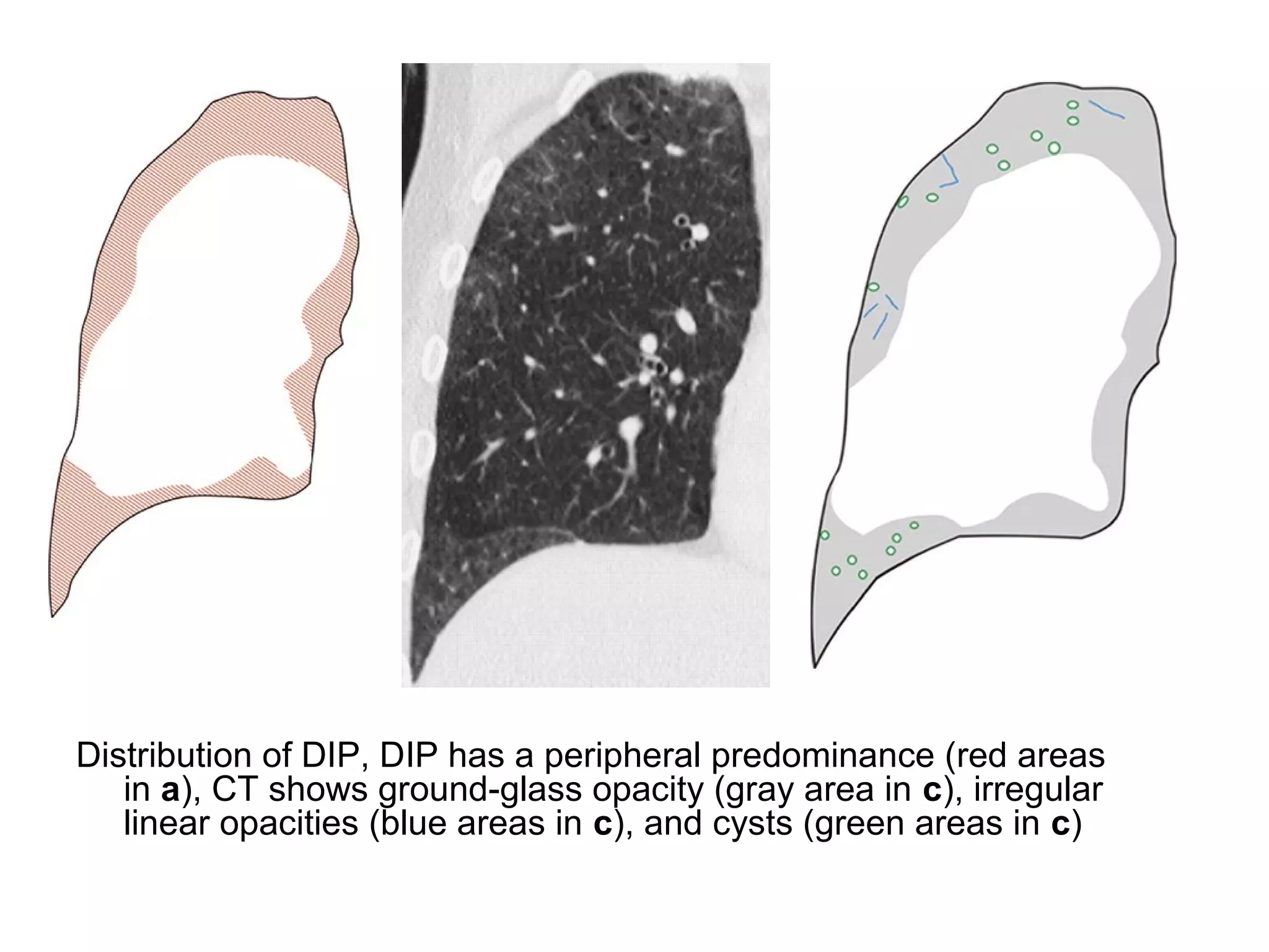 Diagnostic Imaging of Diffuse Lung Lesions | PPT