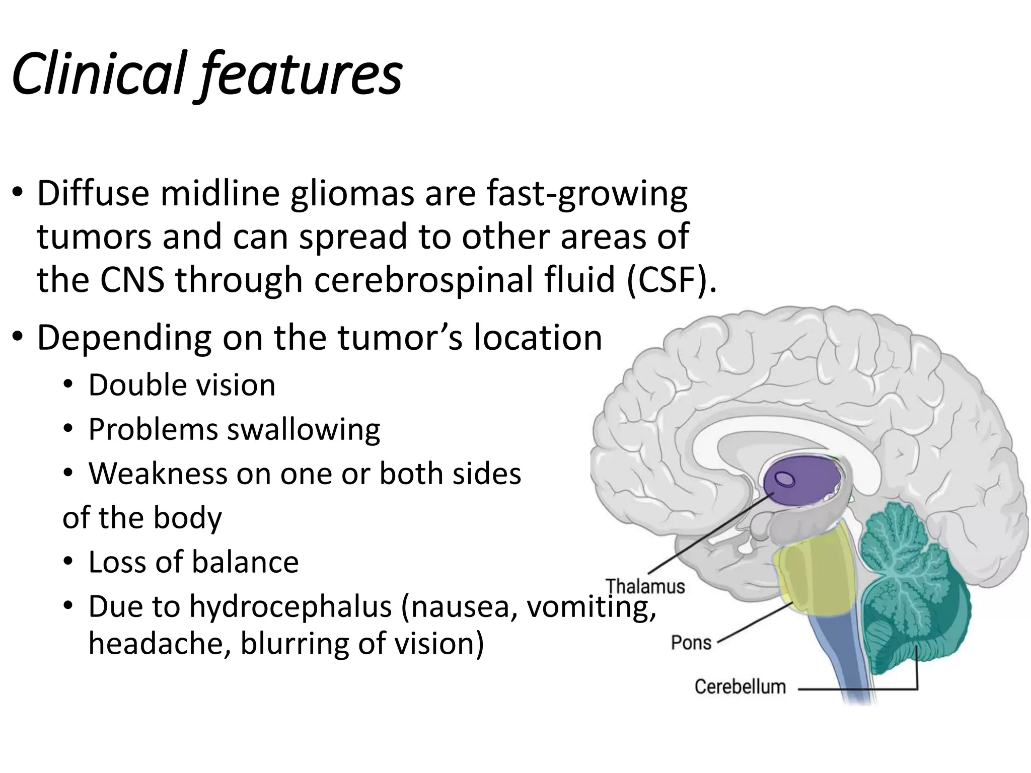 Diffuse Midline Gliomas/ Diffuse Pontine Gliomas.pptx