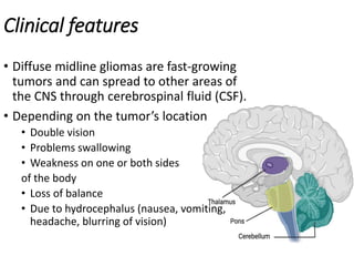 Brainstem Gliomas/ Diffuse Midline Gliomas/ Diffuse Pontine Gliomas.pptx