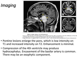 Diffuse Midline Gliomas/ Diffuse Pontine Gliomas.pptx